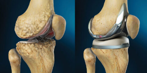 Best Knee Replacement Surgeon in Kalyan | Highland Hospital
